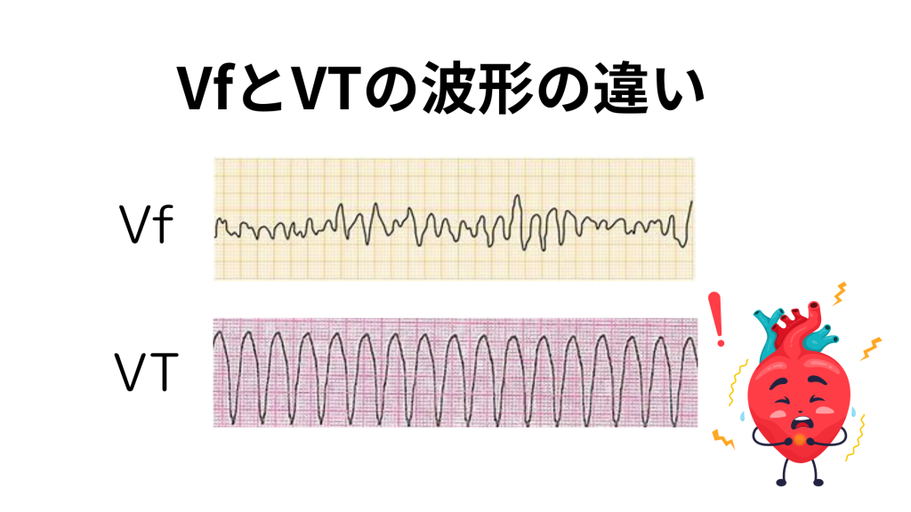 【看護師必見】VT（心室頻拍）の心電図判読と緊急対応|見逃さない4ステップガイド - しごとレトリバーガイド
