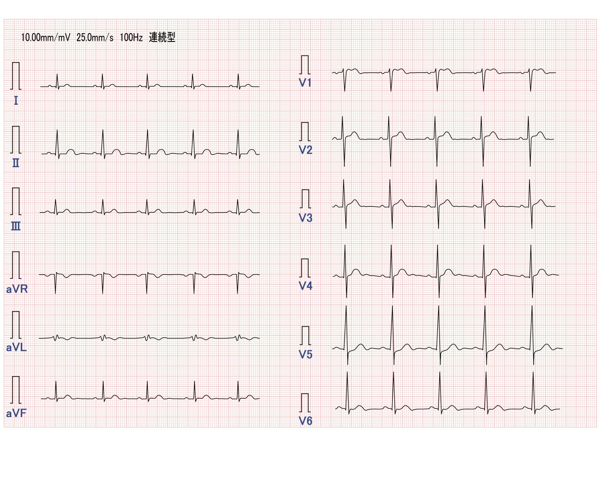 心電図 ST上昇 看護師向け【実践ガイド】バイタル連動で判断する3ステップ - しごとレトリバーガイド