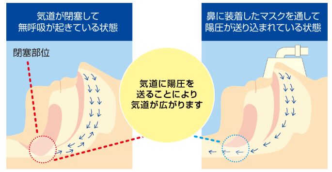 NPPV・CPAP・BIPAP(S/T)の違いとは？モードとマスクの選び方がわかる臨床ガイド - しごとレトリバーガイド