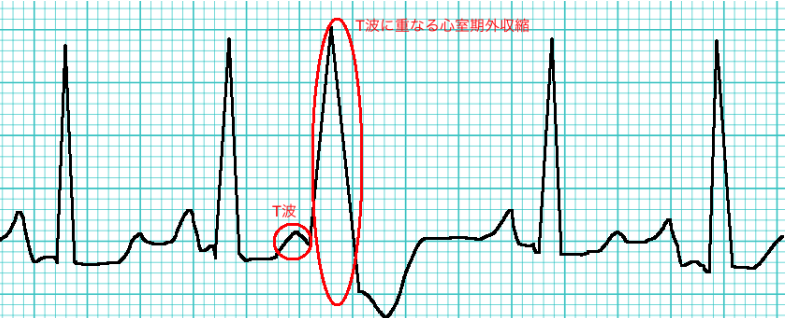 【保存版】PVC期外収縮の波形・重症度・看護対応がまるっとわかる！Lown分類＆フローチャート付き - しごとレトリバーガイド