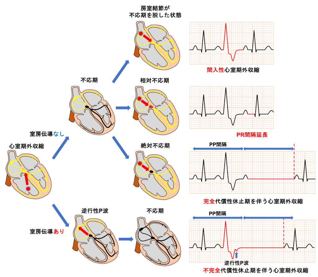 【保存版】PVC期外収縮の波形・重症度・看護対応がまるっとわかる！Lown分類＆フローチャート付き - しごとレトリバーガイド