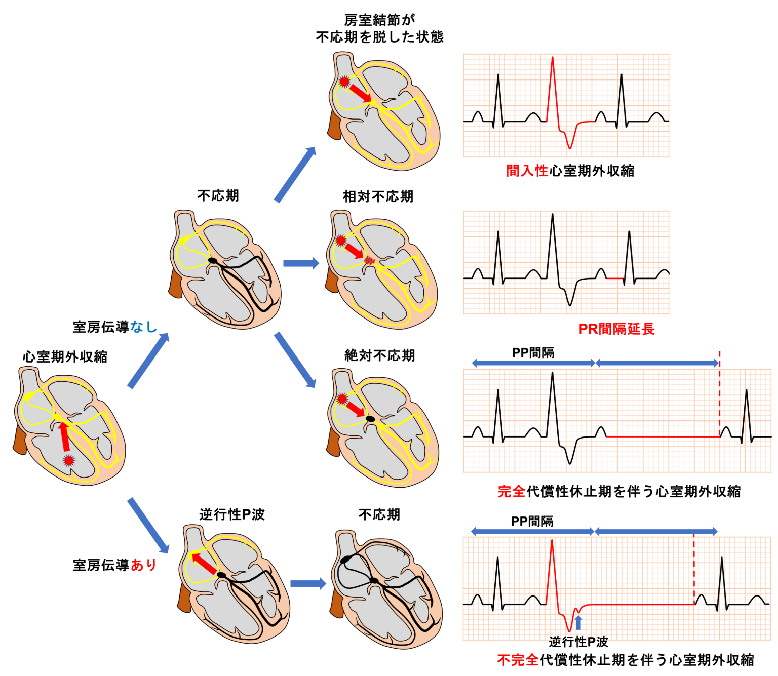 【保存版】PVC期外収縮の波形・重症度・看護対応がまるっとわかる！Lown分類＆フローチャート付き - しごとレトリバーガイド