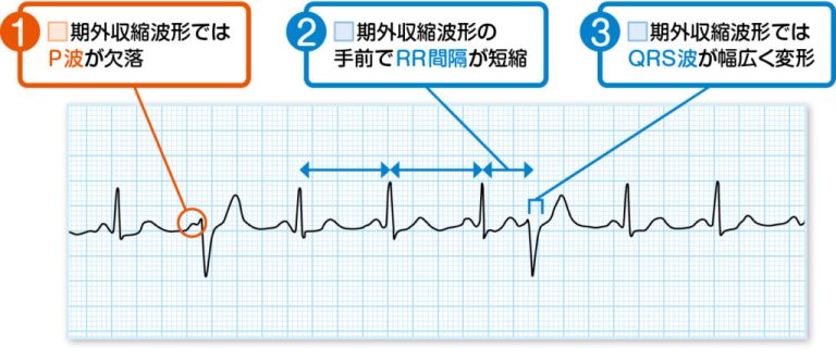 「このPVC、大丈夫？」臨床で迷わない！看護師のためのPVC心電図判読術 - しごとレトリバーガイド
