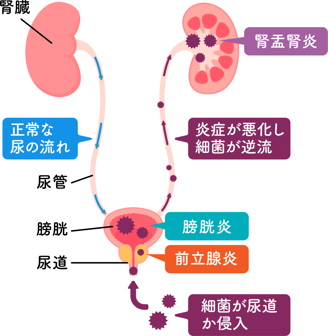尿路感染症（UTI）病態のすべて｜アセスメント・検査値で早期発見 - しごとレトリバーガイド