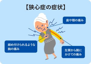 狭心症の看護計画をOP・TP・EPで完全解説！実習・臨床ですぐ使える - しごとレトリバーガイド